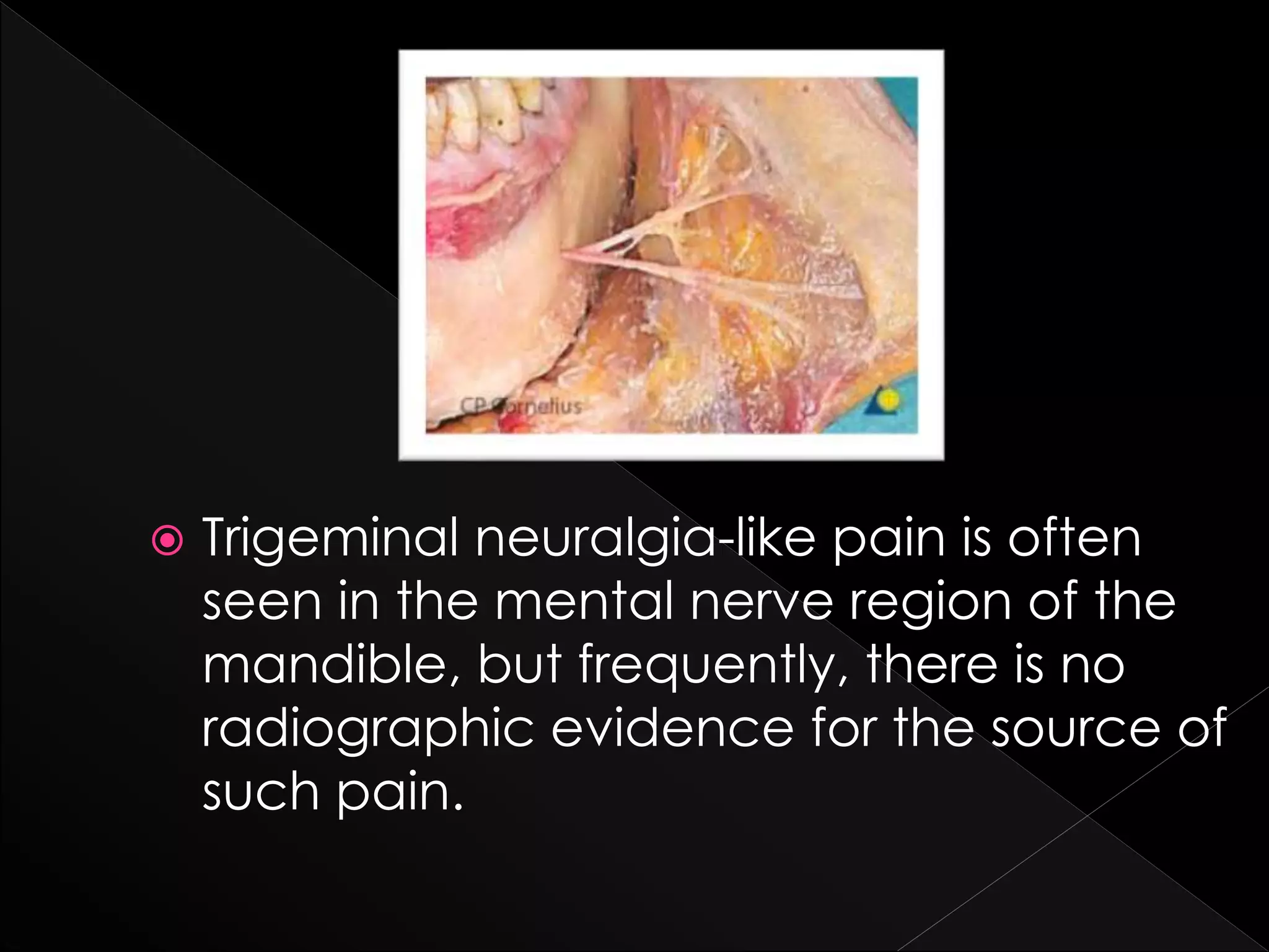 case ppt Mental nerve neuralgia | PPTX | Brain and Nervous System Disorders | Diseases and ...