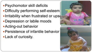mentalretardation-131029012738-phpapp02 (1).pdf