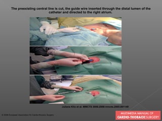 Endomyocardial Biopsy | PPT