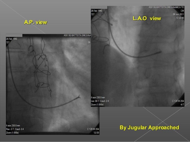 Endomyocardial Biopsy