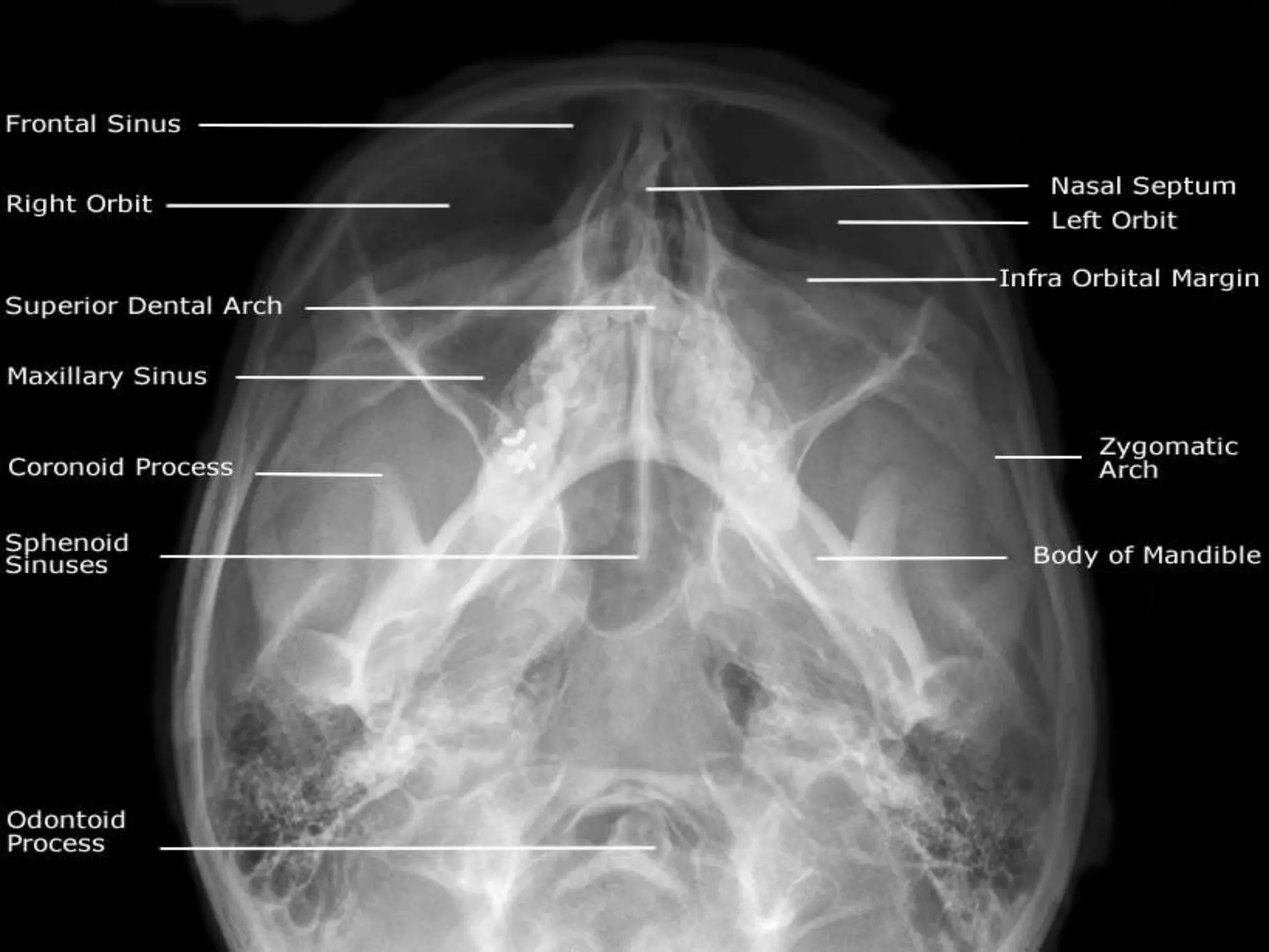landmarks and interpretation in extraoral radiography | PPTX
