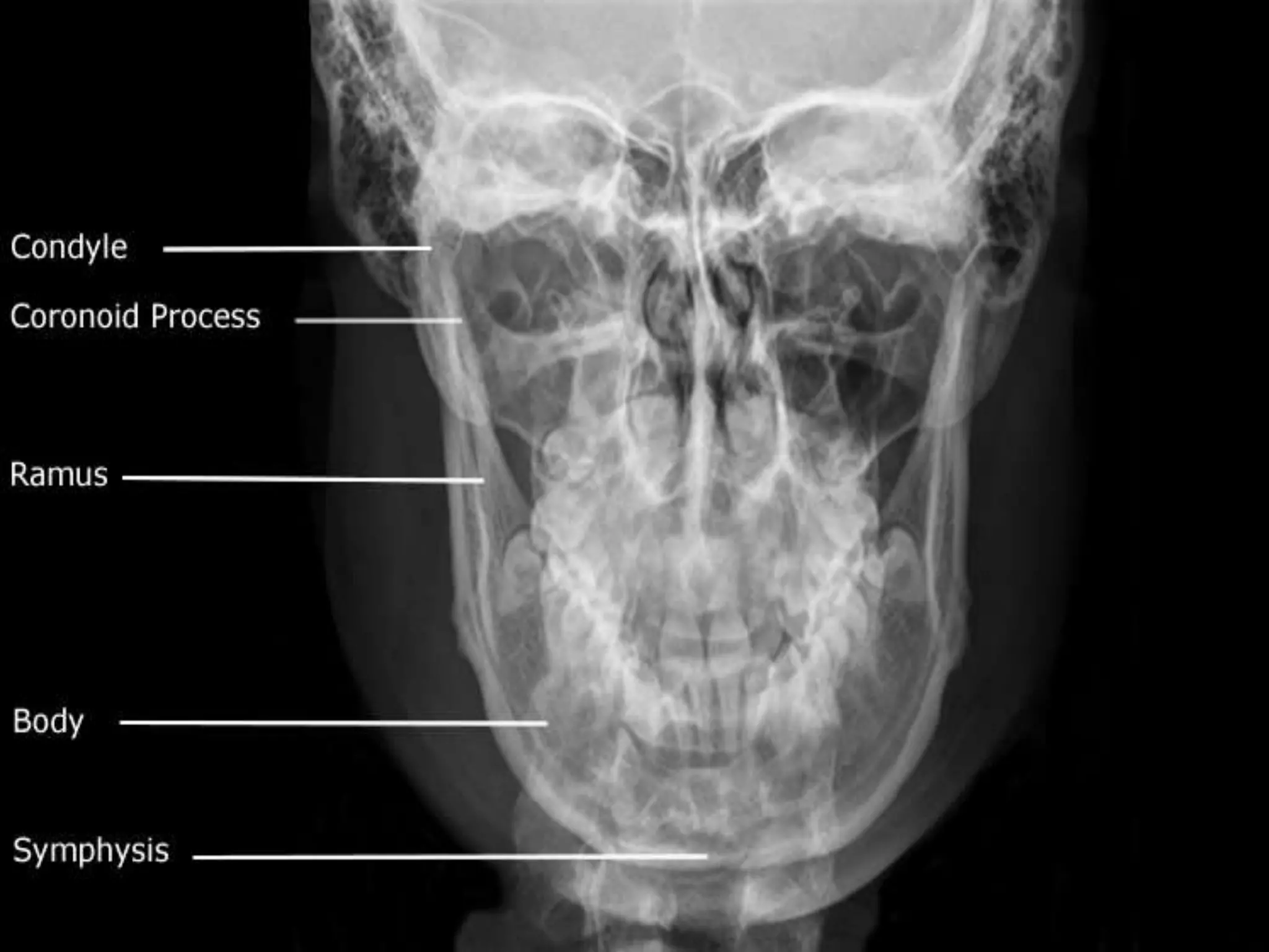 landmarks and interpretation in extraoral radiography | PPTX