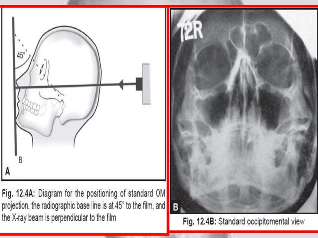 landmarks and interpretation in extraoral radiography | PPTX | Death ...