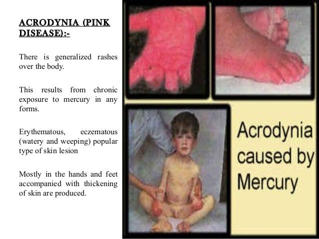 Symptoms of mercury poisoning - fessegg