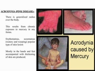 MERCURY POISONING-Forensic Updated Dr.Sadia.pptx