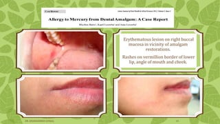 MERCURY TOXICITY | PPTX