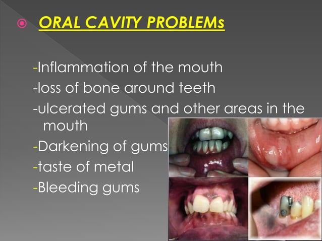 Mercury toxicity & hygiene | PPTX | Dental Health | Diseases and Conditions