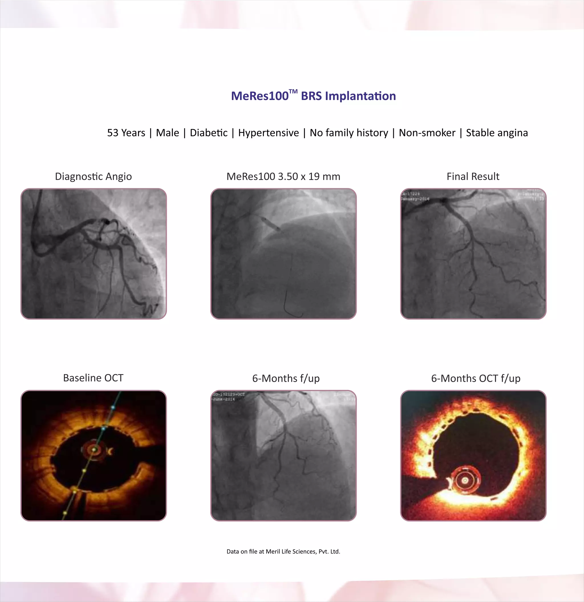 MeRes100 Bioresorbable Scaffolds Brochure | PDF