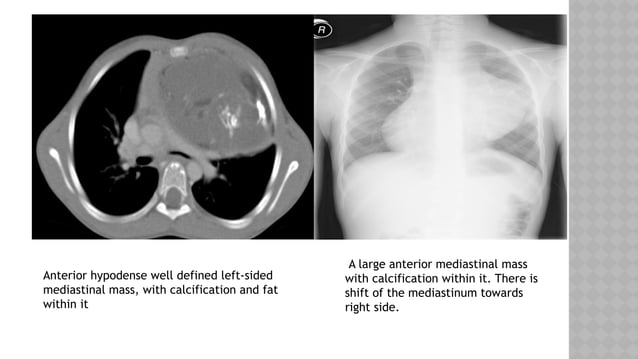 Anterior Mediastinal masses Presentation.PPT