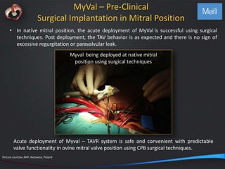 Meril - TAVI | PDF