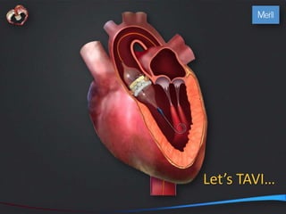 Meril - TAVI | PDF