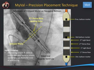 Meril - TAVI | PDF