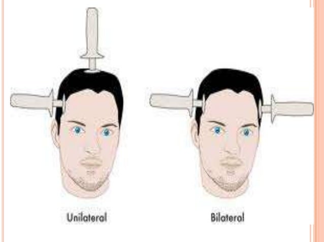 Electroconvulsive Therapy (ECT) | PPTX | Physical Therapy | Wellness