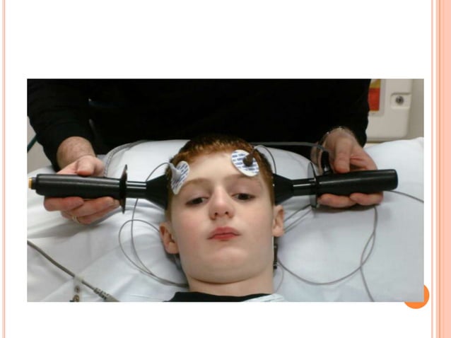 Electroconvulsive Therapy (ECT) | PPTX | Physical Therapy | Wellness