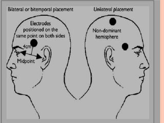 Placement Of Electrodes In Electroconvulsive Therapy