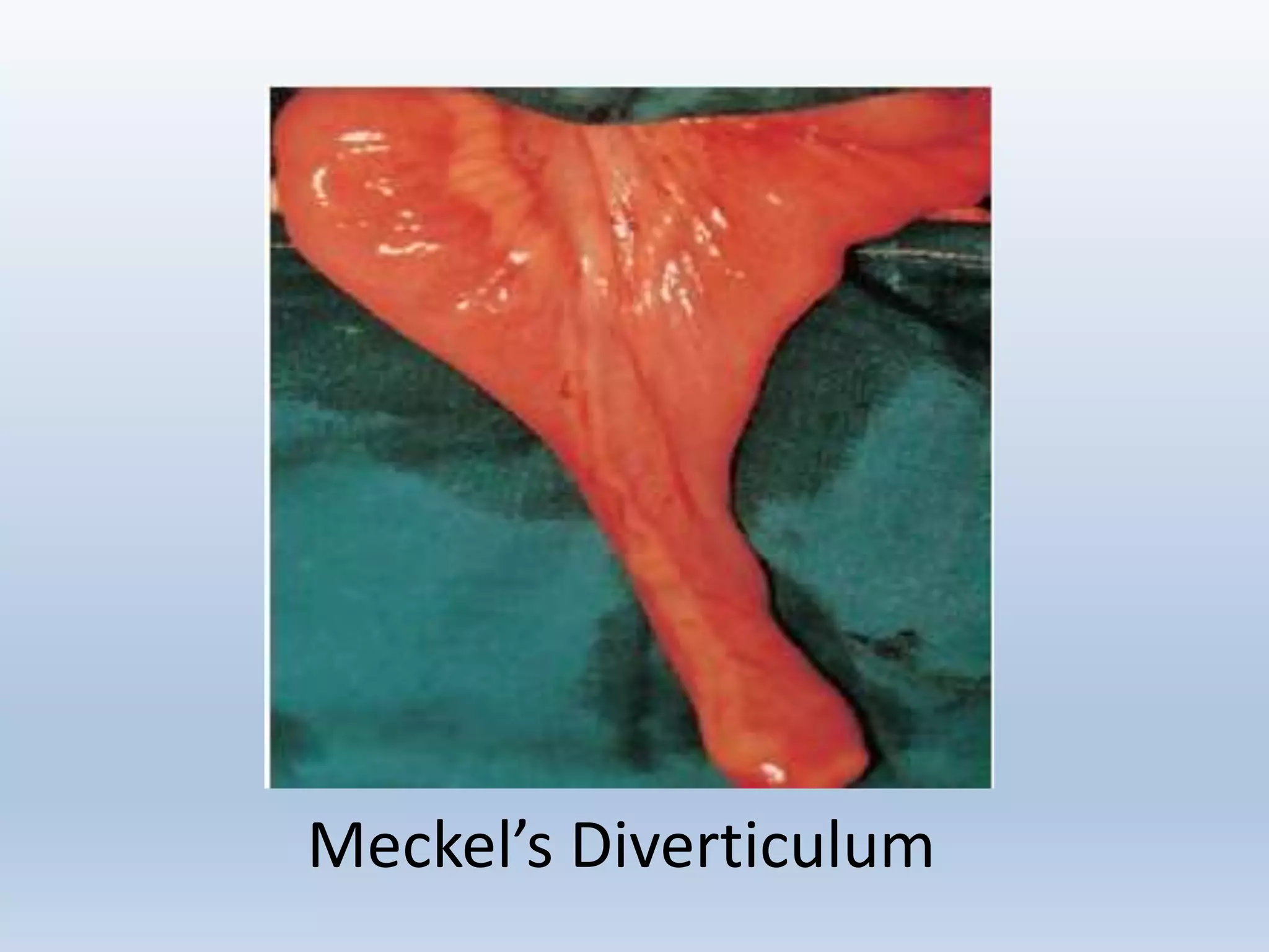 Merkel's diverticulum | PPTX
