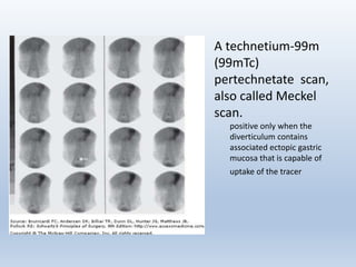 Merkel's diverticulum | PPTX