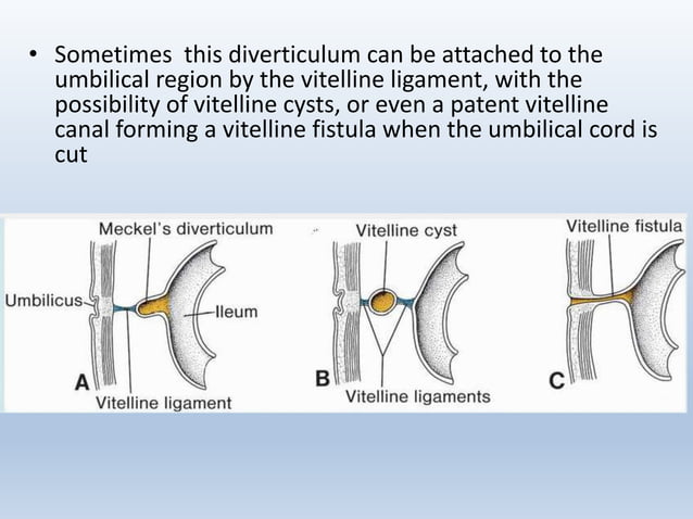 Merkel's diverticulum | PPTX