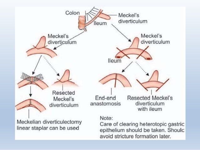 Merkel's diverticulum