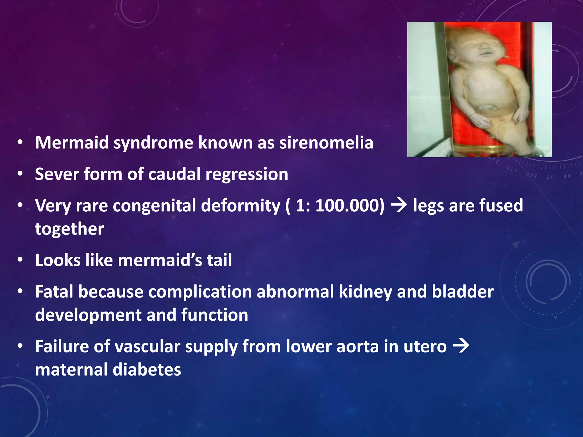 Mermaid syndrome. medi | PPTX