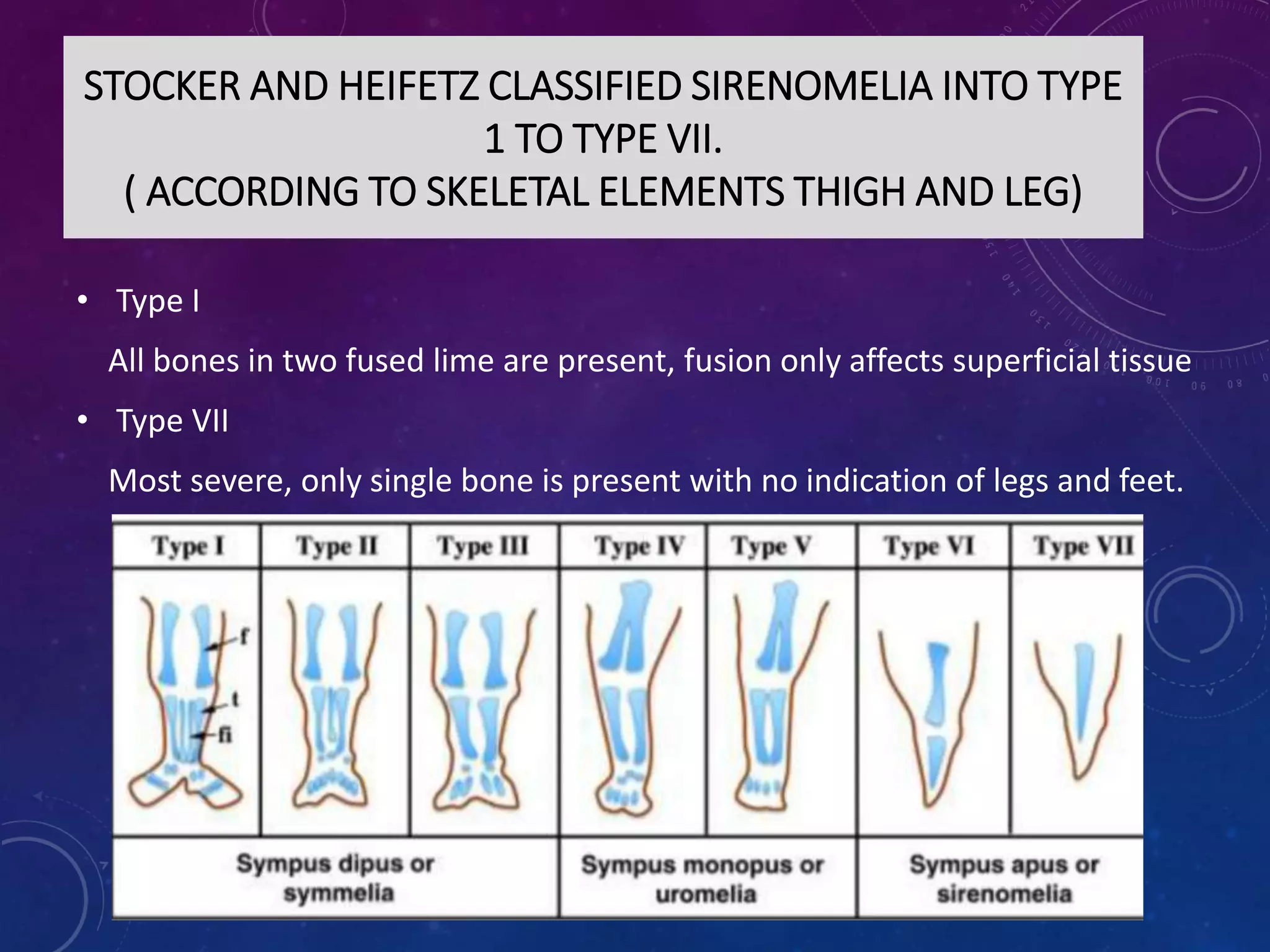 Mermaid syndrome. medi | PPTX