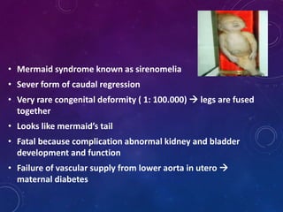 Sirenomelia Causes