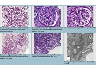 Mesangial Proliferative Glomerulonephritis