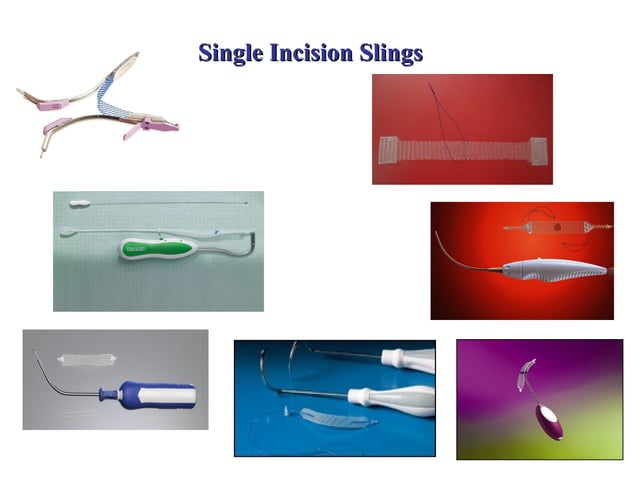 Single Incision Slings Il presente nel trattamento della IUS | PPT