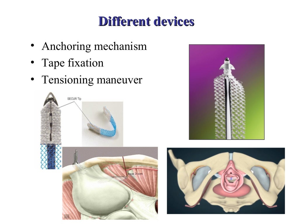 Single Incision Slings Il presente nel trattamento della IUS