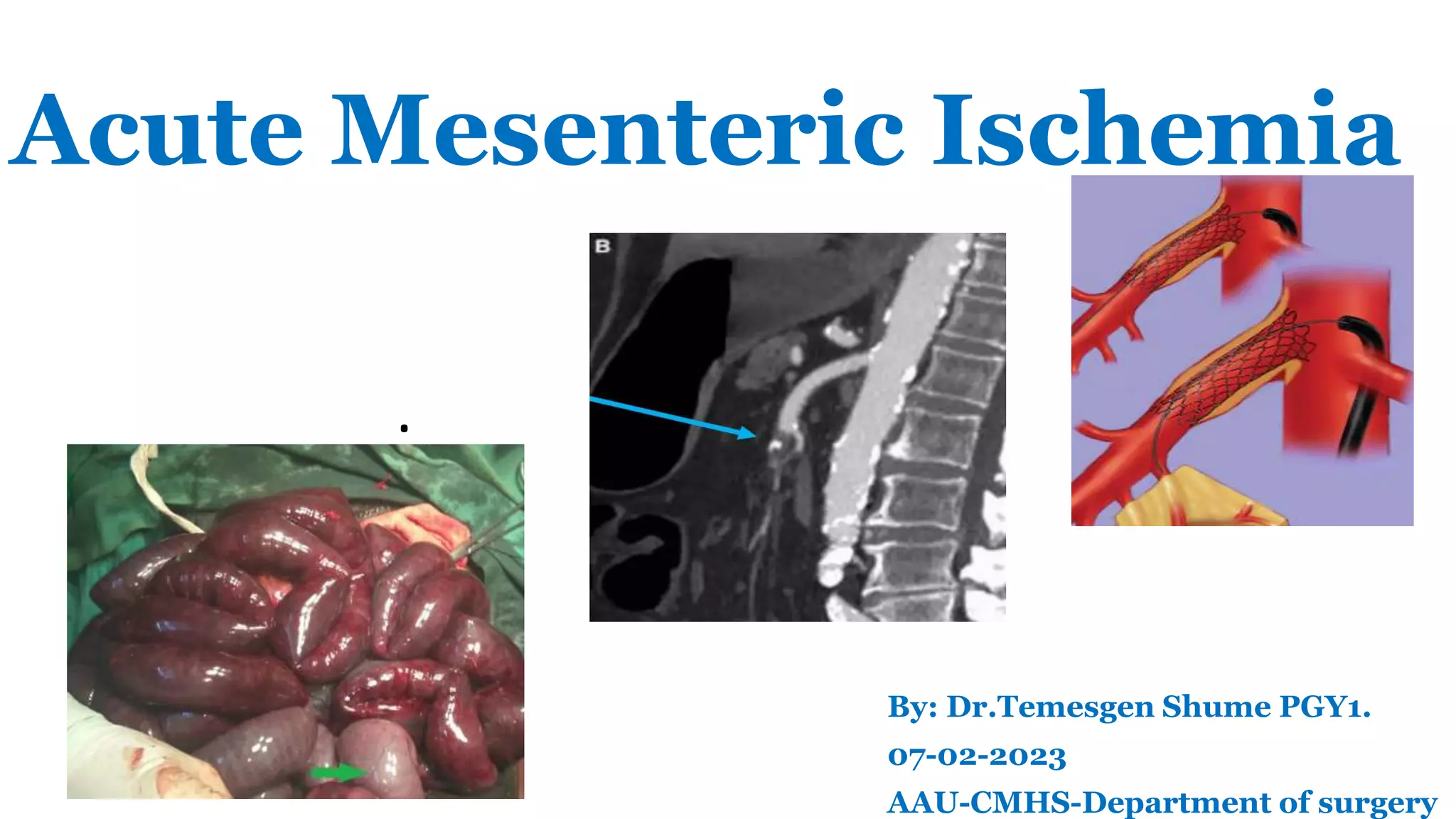 Acute Mesenteric Ischemia.pptx Addis Ababa Uriversity, Ethiopia | PPTX