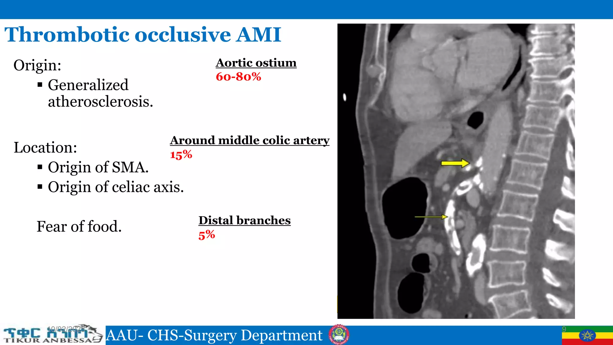 Acute Mesenteric Ischemia.pptx Addis Ababa Uriversity, Ethiopia | PPTX