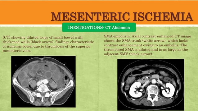 Mesenteric ischemia/ Generalised abdominal pain