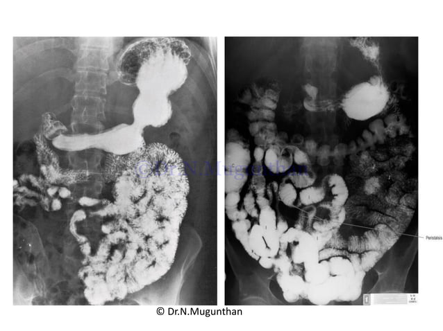 Mesentery, jejunum, ileum & superior mesenteric artery -PDF Lecture ...