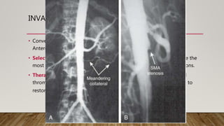 Mesentric ischemia | PPTX