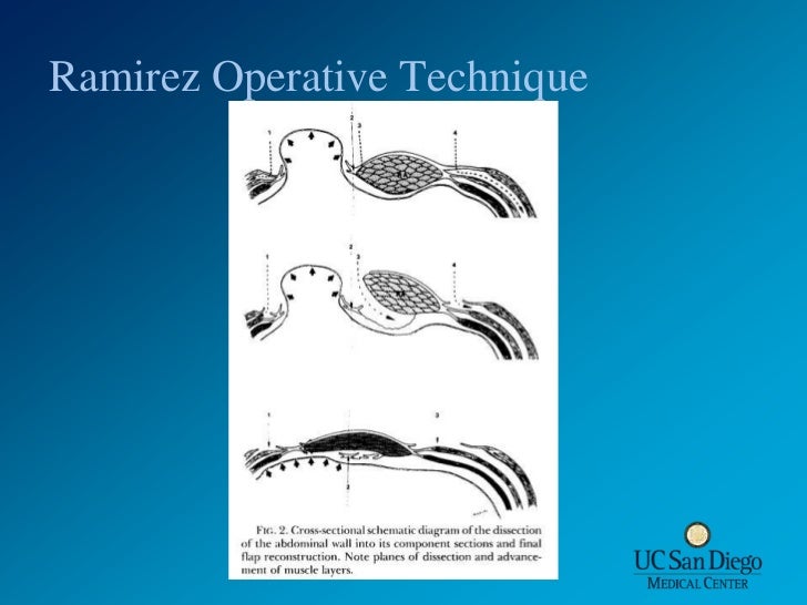 Meshes and bariatric surgery for argentina