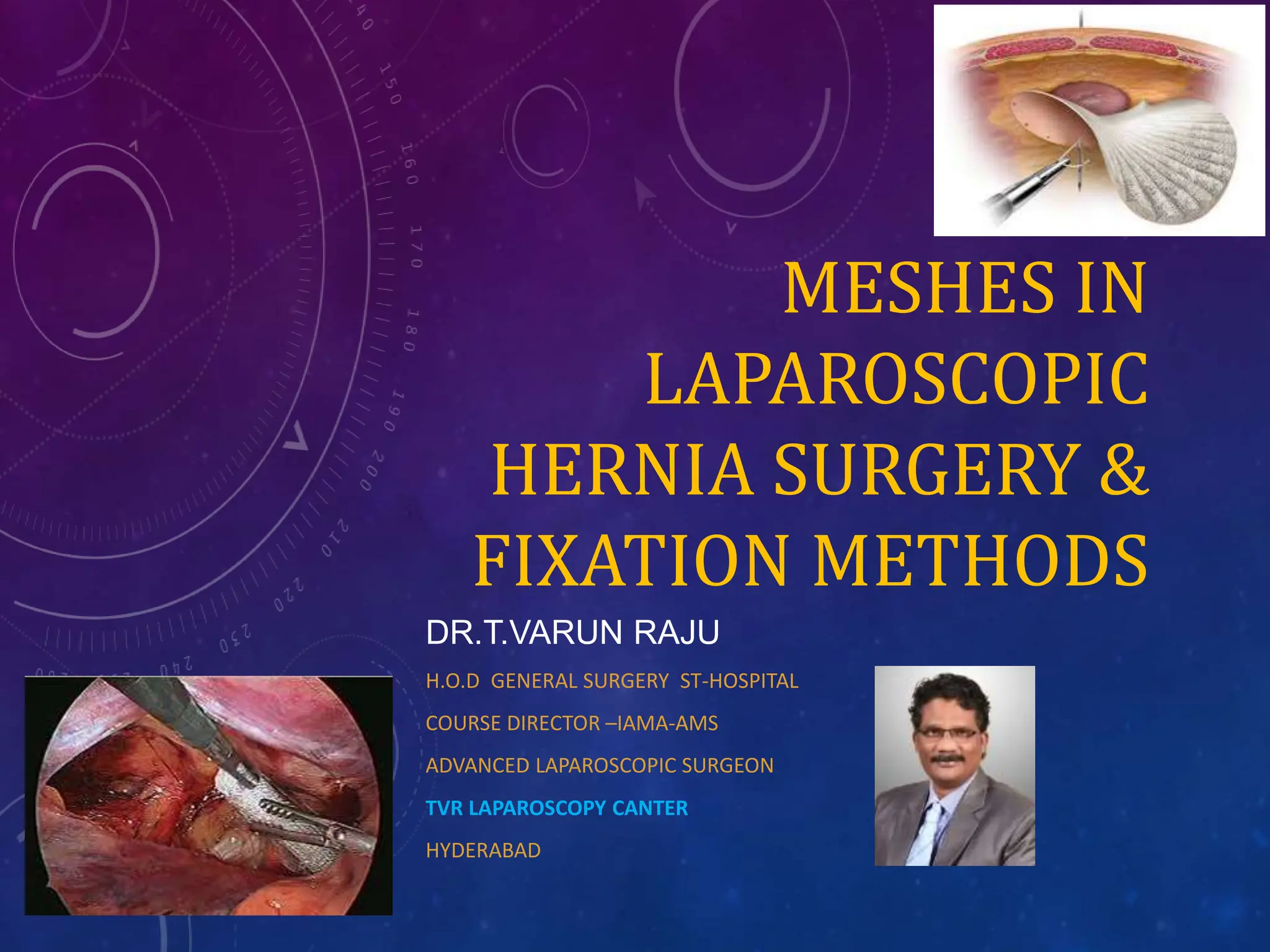 MESHES AND METHODS OF FIXATION.pptx