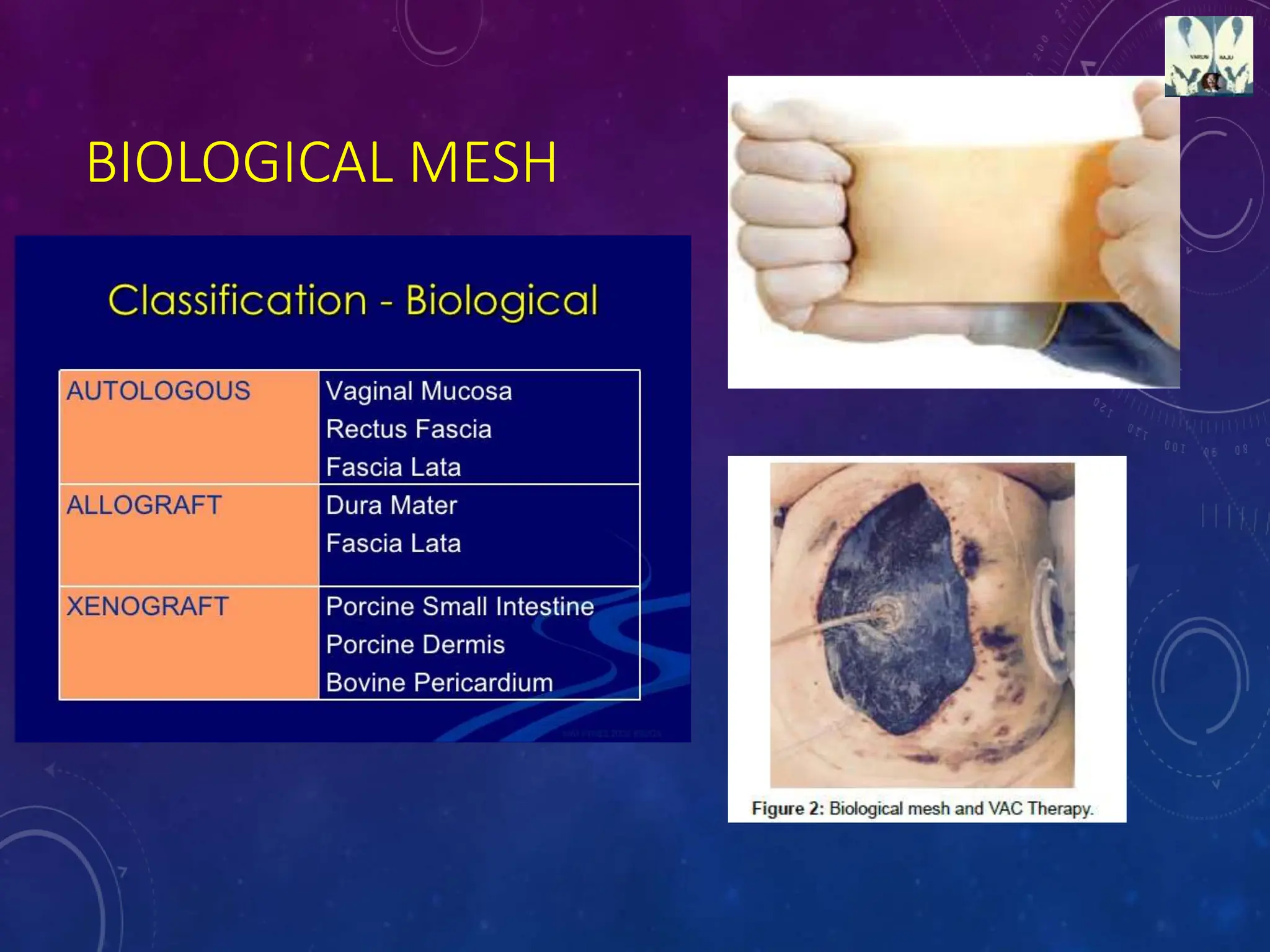 MESHES AND METHODS OF FIXATION.pptx