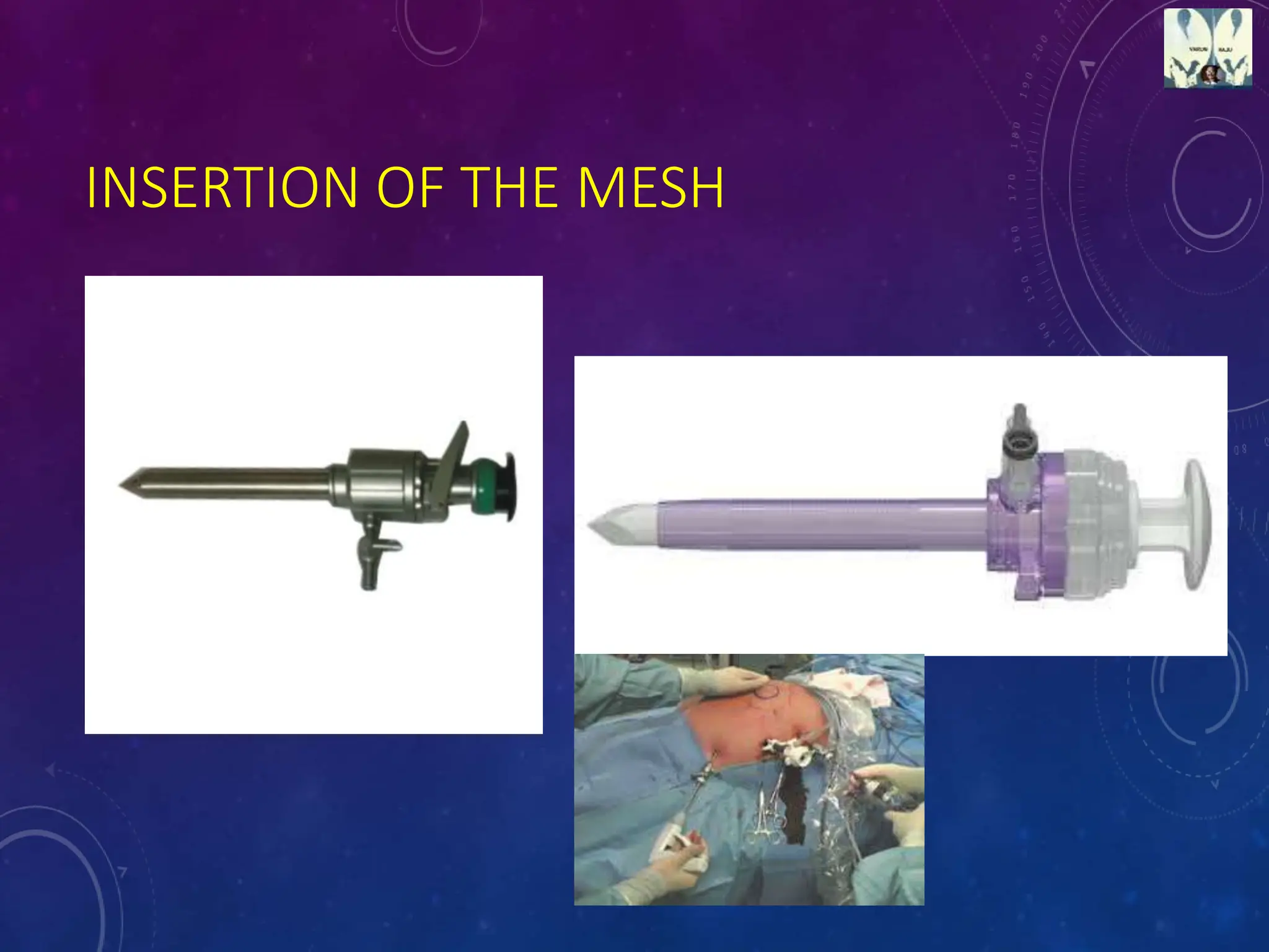 MESHES AND METHODS OF FIXATION.pptx
