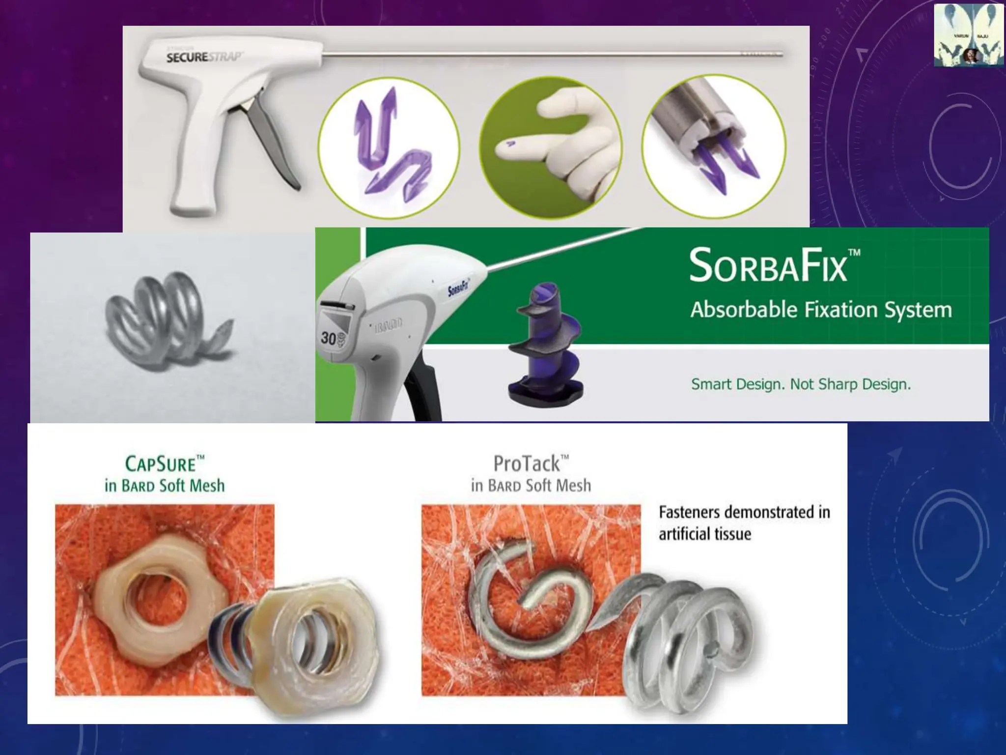 MESHES AND METHODS OF FIXATION.pptx