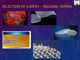 MESHES AND METHODS OF FIXATION.pptx