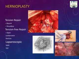 MESHES AND METHODS OF FIXATION.pptx