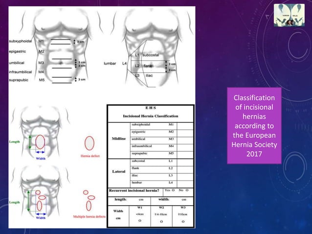 MESHES AND METHODS OF FIXATION.pptx