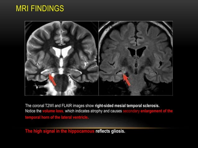 Mesial temporal lobe epilepsy