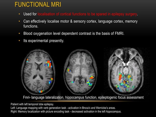 Mesial temporal lobe epilepsy