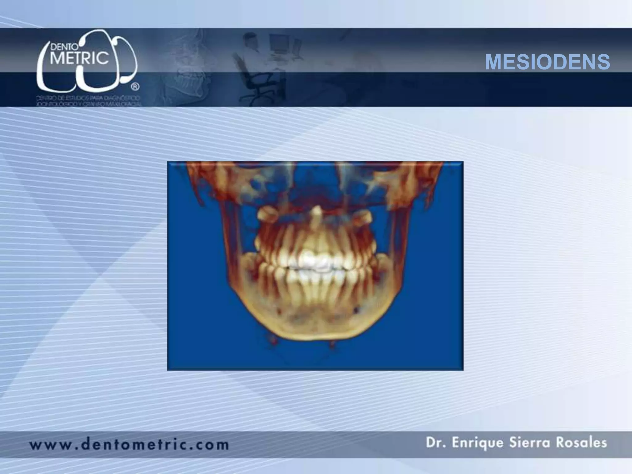 Mesiodens | PPTX | Dental Health | Diseases and Conditions