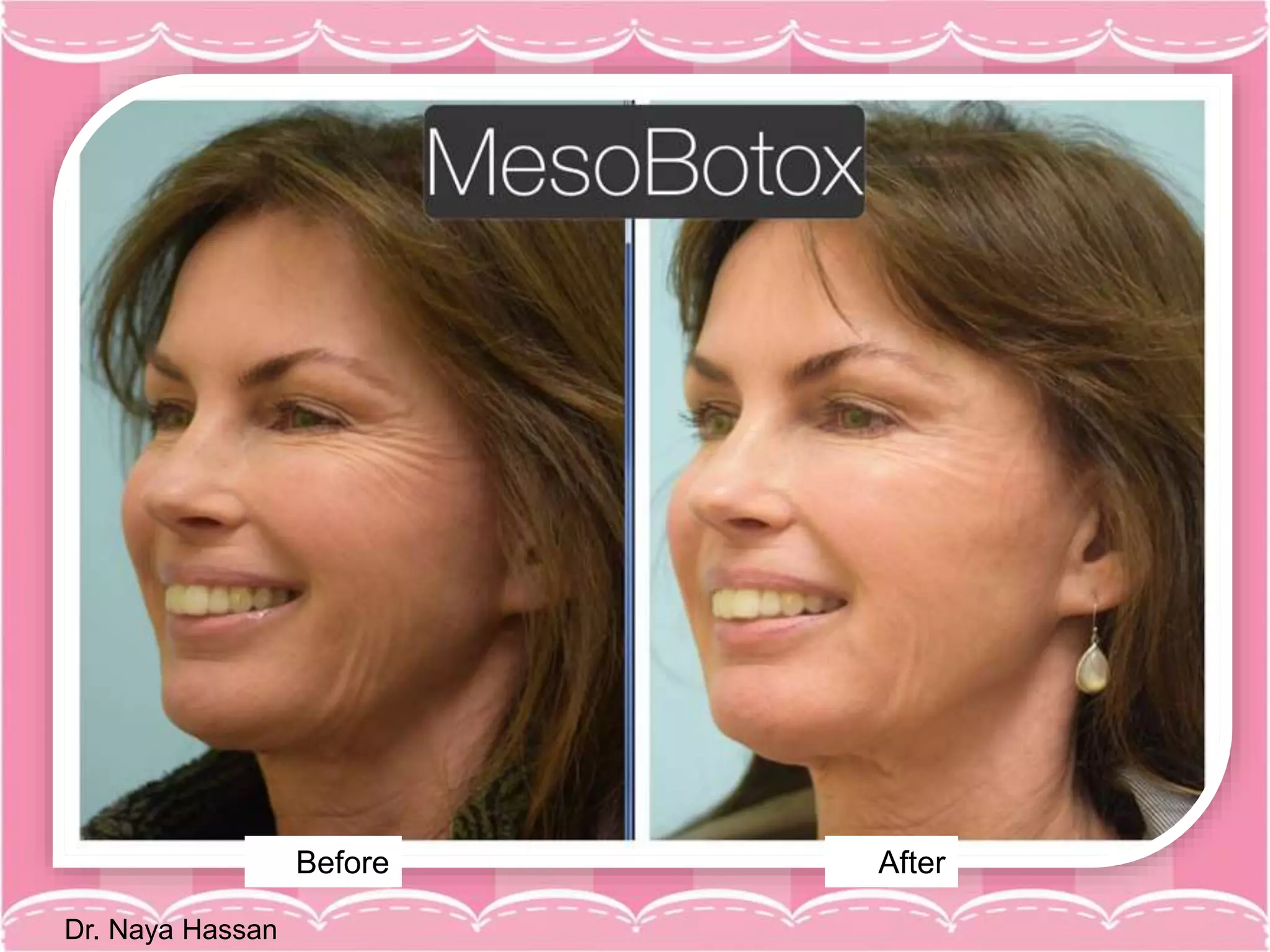 Mesobotox: a New Technique for Aesthetic Treatments | PPTX