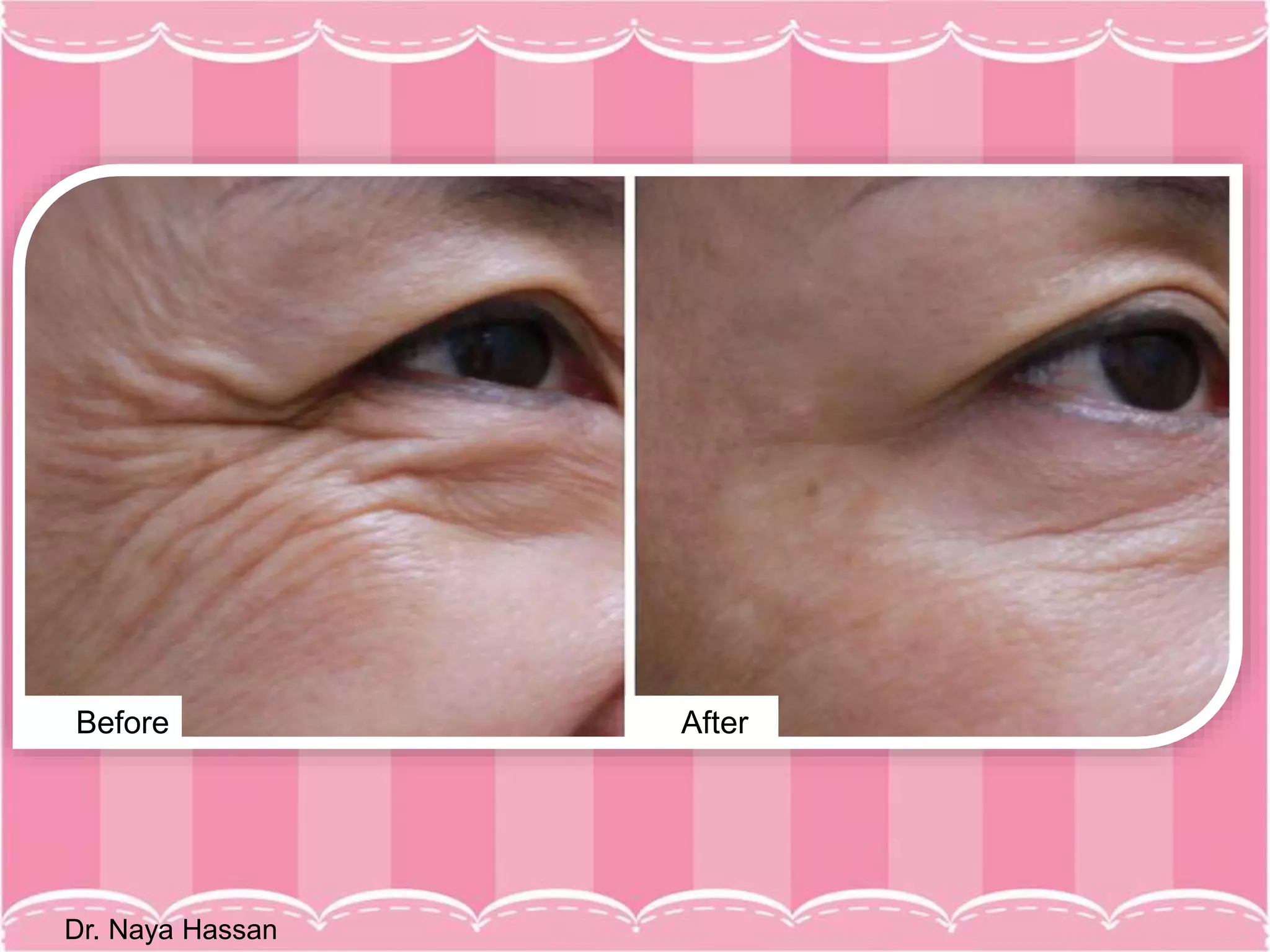 Mesobotox: a New Technique for Aesthetic Treatments | PPTX