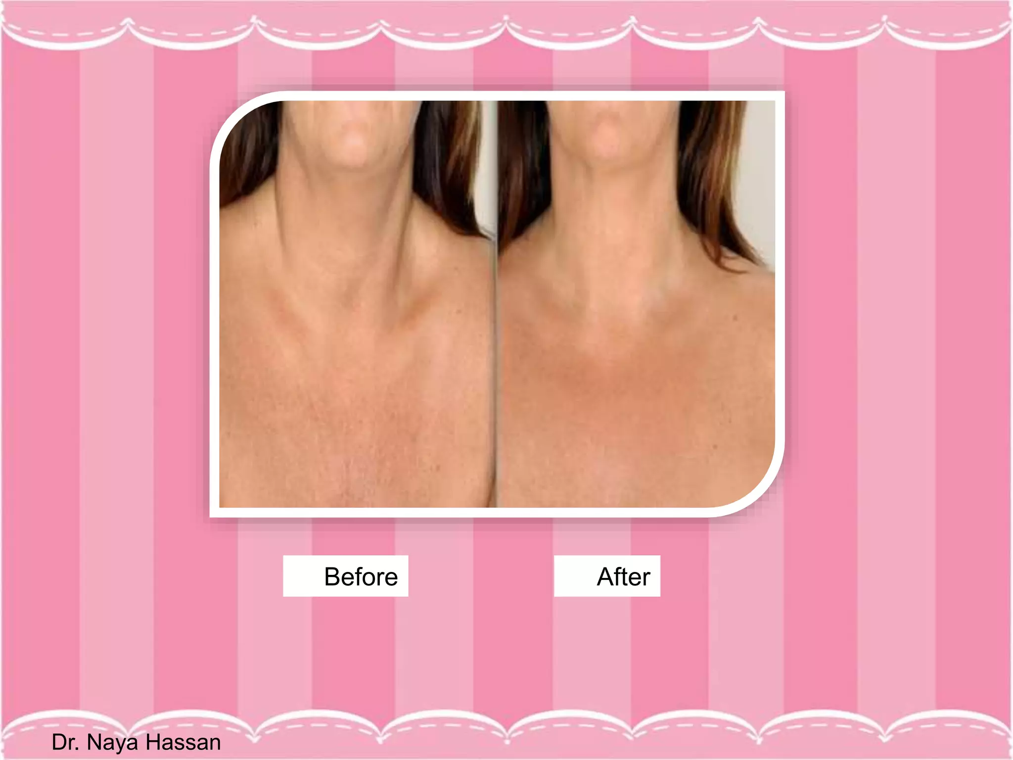 Mesobotox: a New Technique for Aesthetic Treatments | PPTX