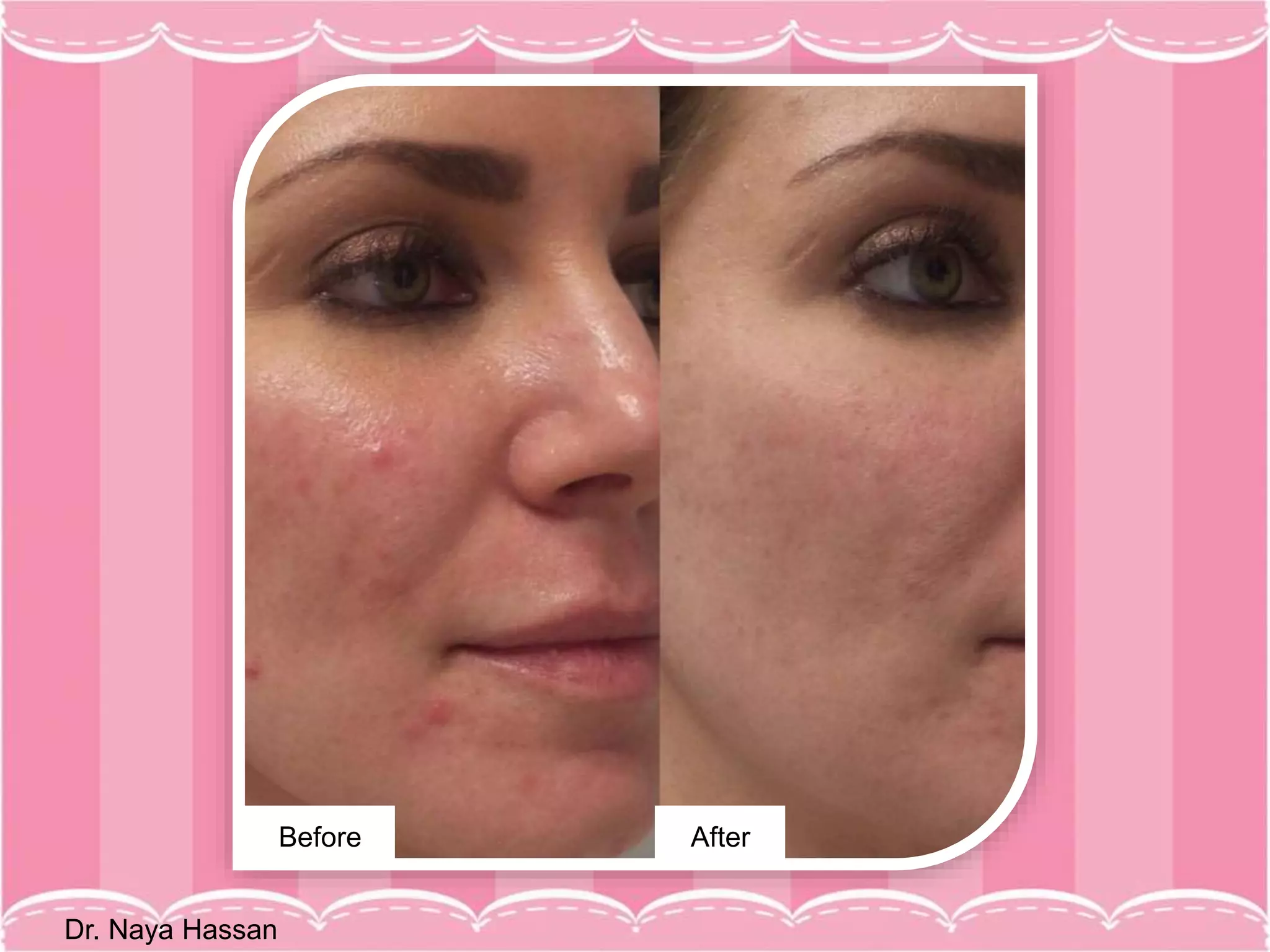 Mesobotox: a New Technique for Aesthetic Treatments | PPTX