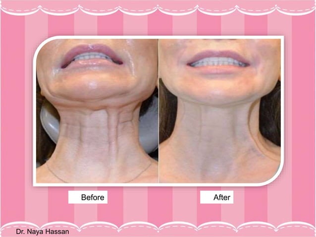 Mesobotox: a New Technique for Aesthetic Treatments | PPTX